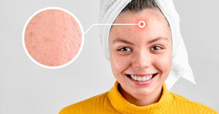Cómo eliminar el acné hormonal de forma natural