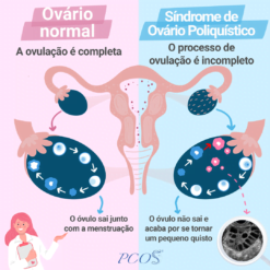 Quistos nos ovários, quais os sintomas?